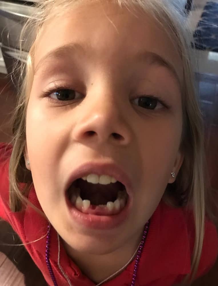 Darn You Danglers The Loose Baby Teeth That Won T Let Go